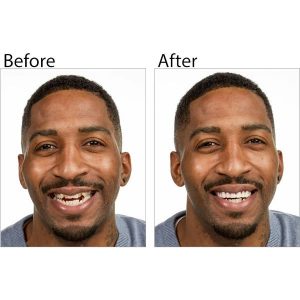 Perfect Smile Veneers - As Seen On TV Tech